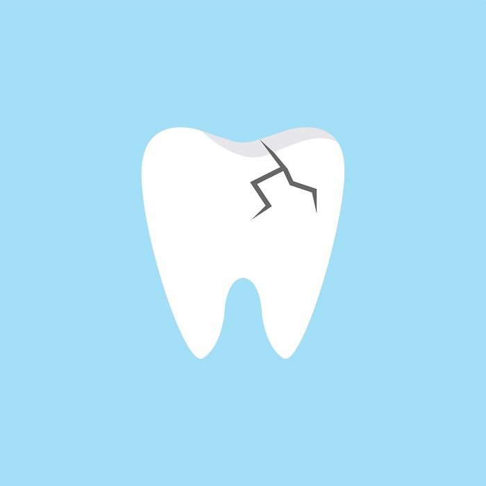 Tooth Fracture FAQs - Emergency Dentist in Suffolk, VA